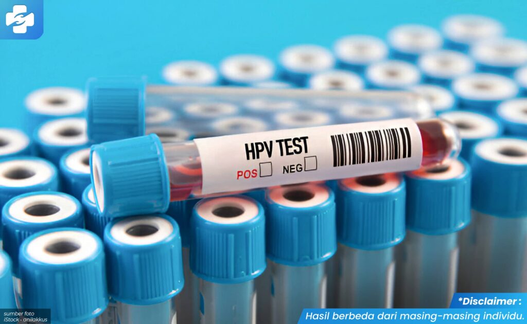 Apakah Infeksi Virus HPV Bisa Sembuh Total? Ini Kata Ahlinya