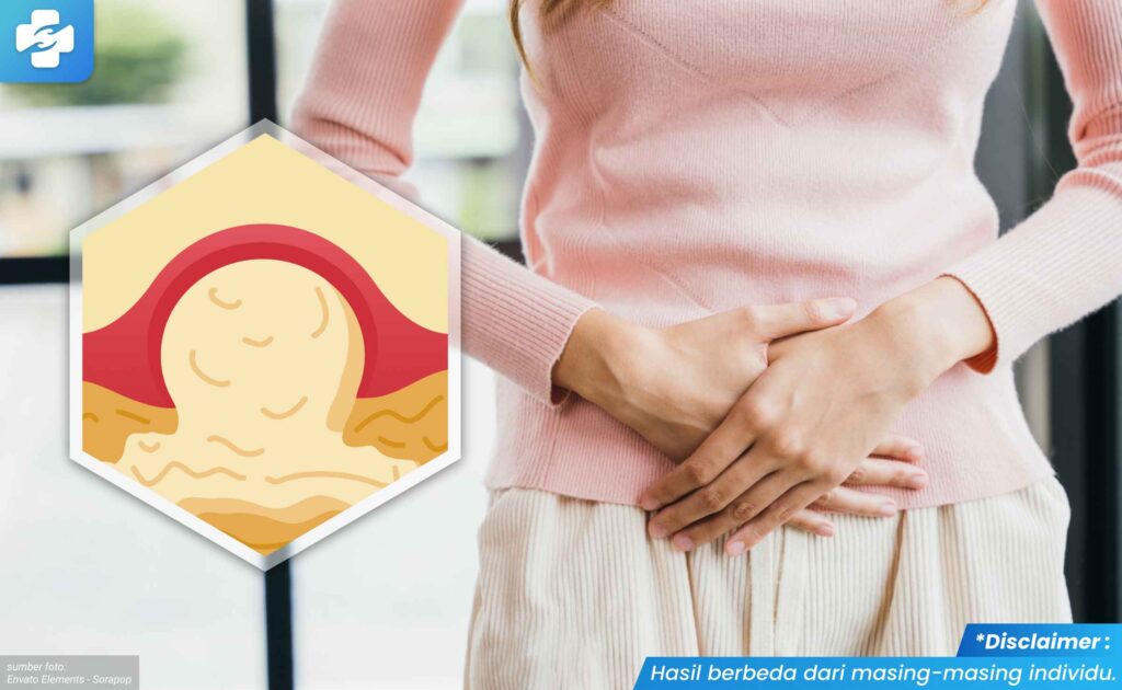 Kista Bartholin Tumbuh Lagi, Begini Cara Mengatasinya!